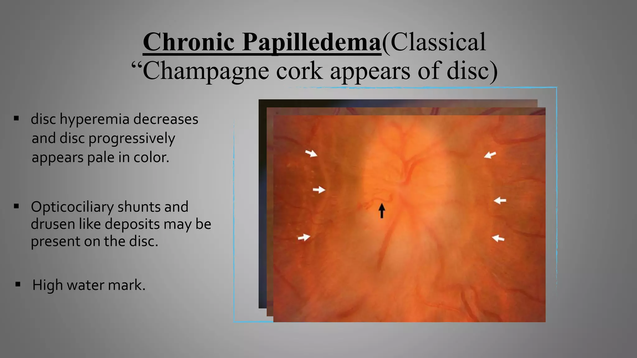 Papilledema - Dr Shylesh Dabke | PPTX