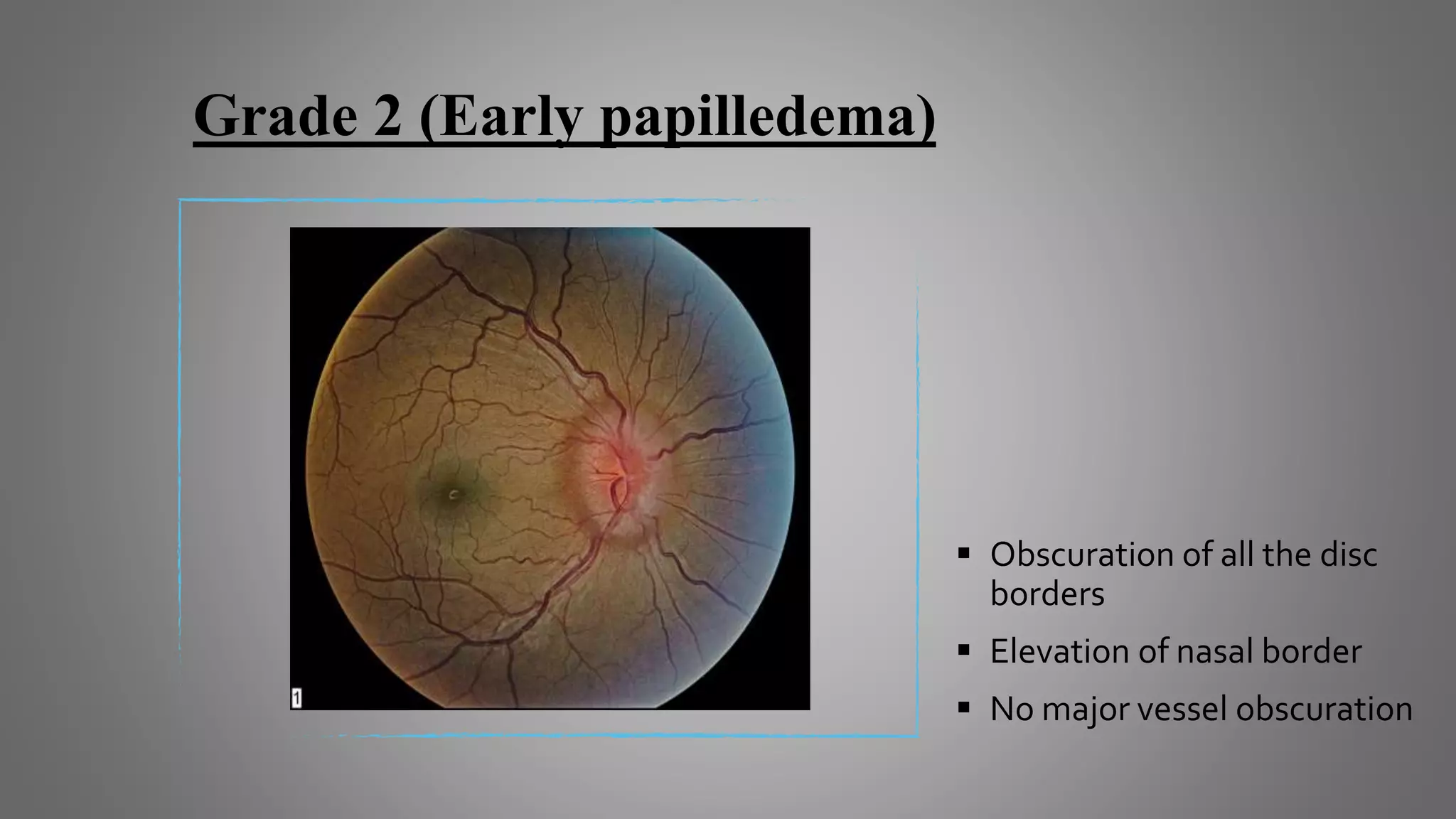 Papilledema - Dr Shylesh Dabke | PPTX