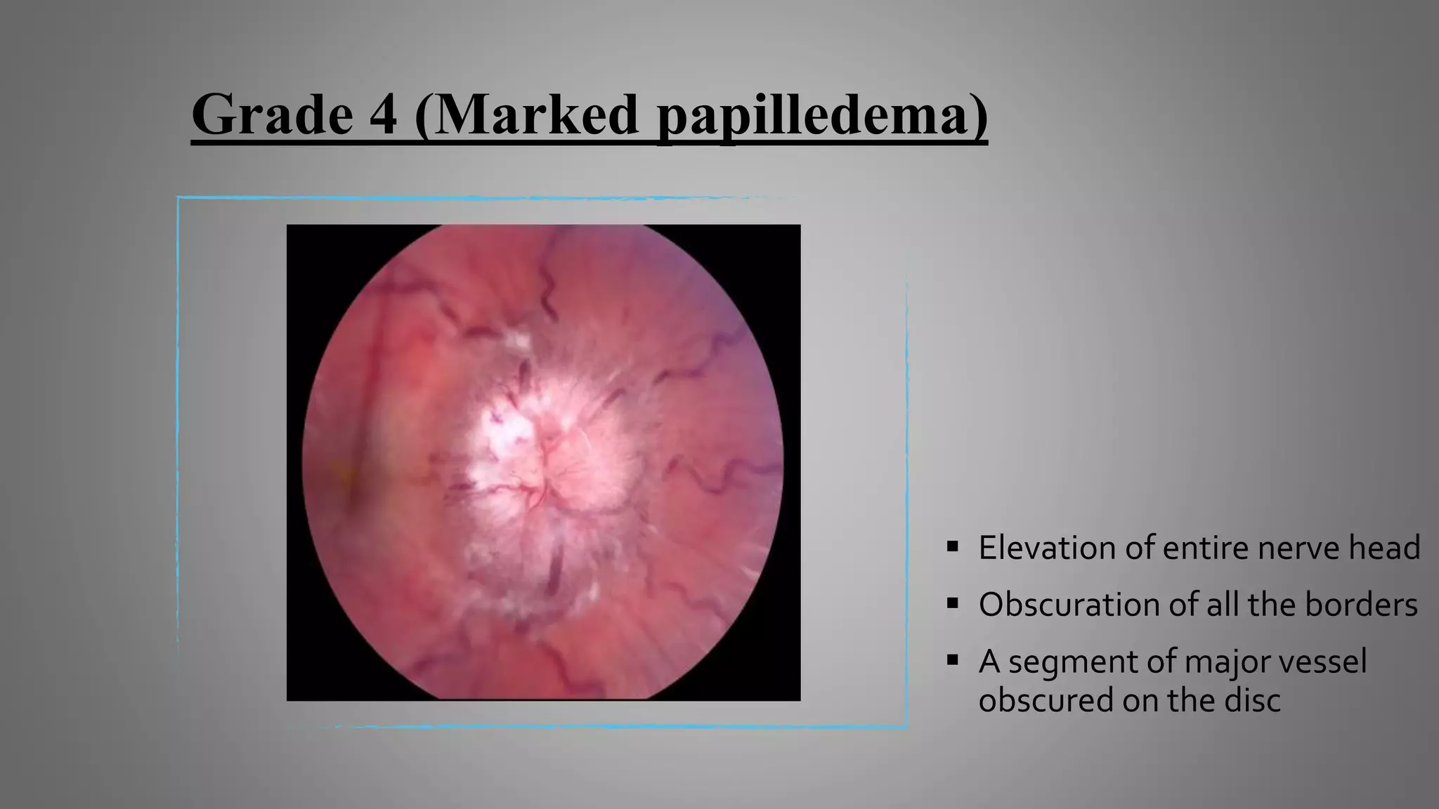 Papilledema - Dr Shylesh Dabke | PPTX