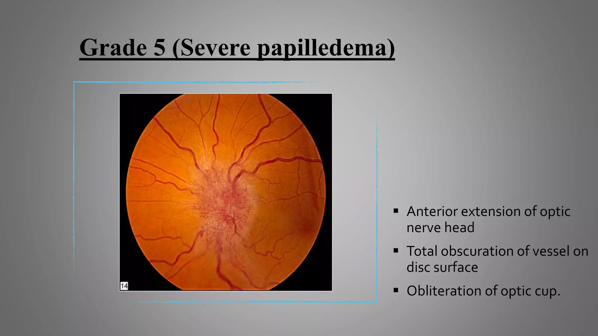 Papilledema - Dr Shylesh Dabke | PPTX