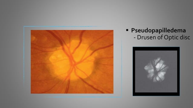 Papilledema - Dr Shylesh Dabke | PPTX | Eye and Vision Conditions ...