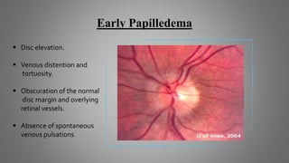 Papilledema - Dr Shylesh Dabke | PPT