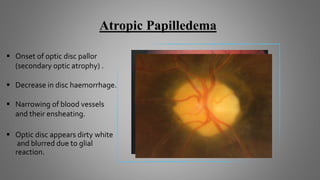 Papilledema Grading