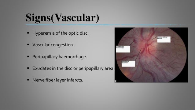 Papilledema - Dr Shylesh Dabke