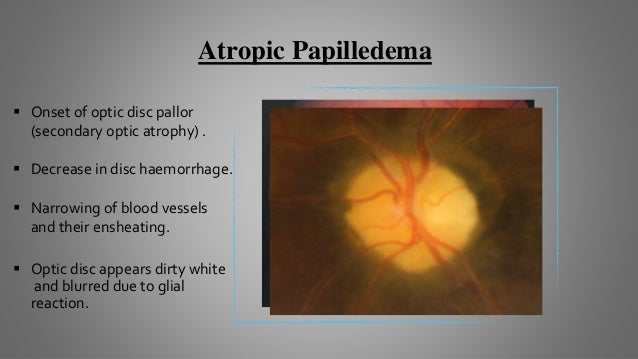 Papilledema - Dr Shylesh Dabke