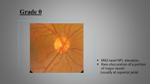 Papilledema Grading Papilledema Dr Shylesh Dabke