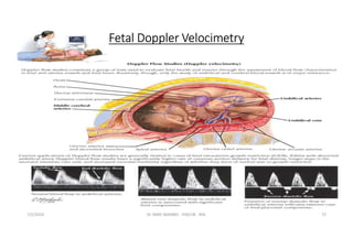 Dr Simo - Fetal Distress and Neonatal Asphyxia.pdf