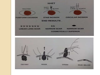Narrow Hole Extrusion Technique | PPT