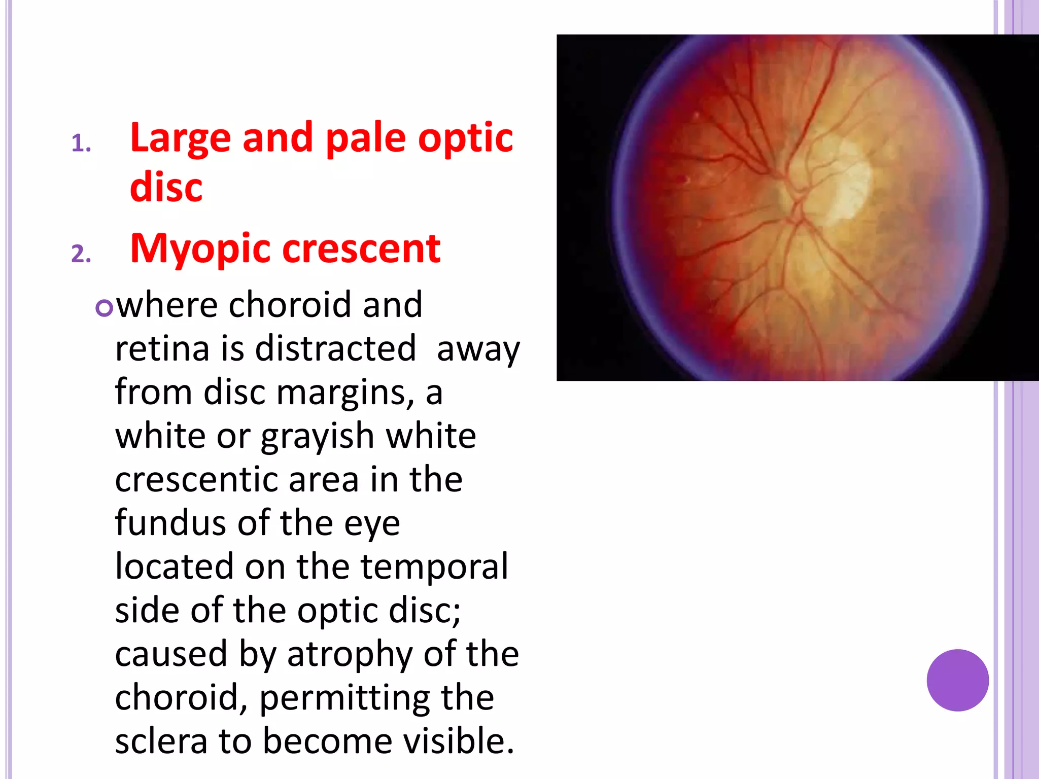 DR SONAL Myopia and astigmatism.pptx | Eye and Vision Conditions | Diseases and Conditions
