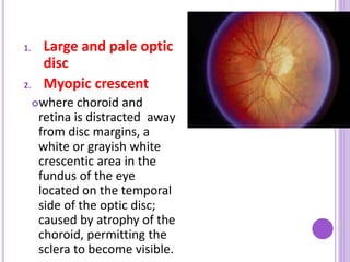 DR SONAL Myopia and astigmatism.pptx