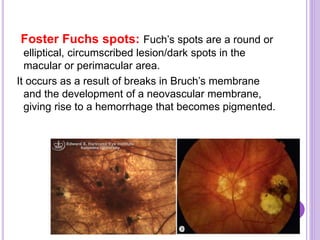DR SONAL Myopia and astigmatism.pptx