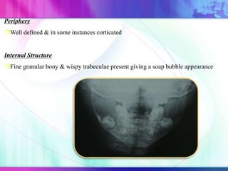 unilocular and multilocular radiolucencies | PPTX