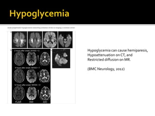 Neurological Evaluation of Acute Ischemic stroke in Emergency Room | PPTX