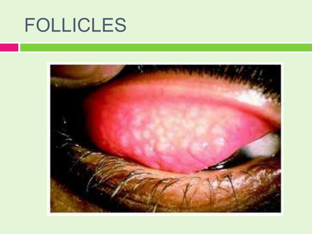 Dr.s.veni priya 11.2.16 chronic conjunctivitis