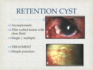 Conjunctival Retention Cyst