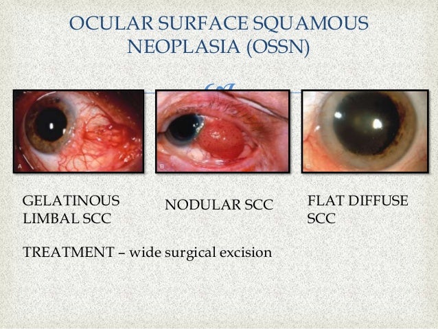 Dr.s.veni priya 18.2.16 deg cyst tumors