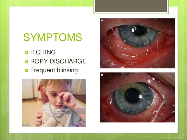 Dr.s.veni priya17.2.16 ni conj & xerophthalmia