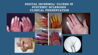 Scleroderma Overview & Insights | PPT