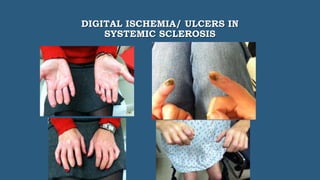 Scleroderma Overview & Insights | PPTX