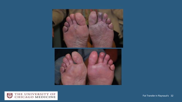 Scleroderma Overview & Insights | PPT