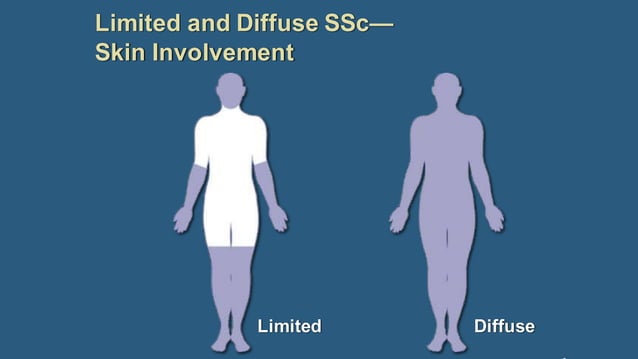 Scleroderma Overview & Insights | PPT