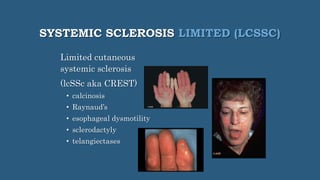 Scleroderma Overview & Insights | PPT