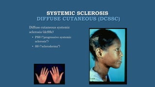 Scleroderma Overview & Insights | PPT