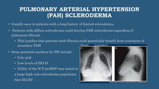 Scleroderma Overview & Insights | PPT