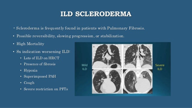 Scleroderma Overview & Insights