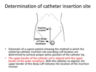 Modified Seldinger Peritoneal Dialysis Catheter Insertion:, 54% OFF