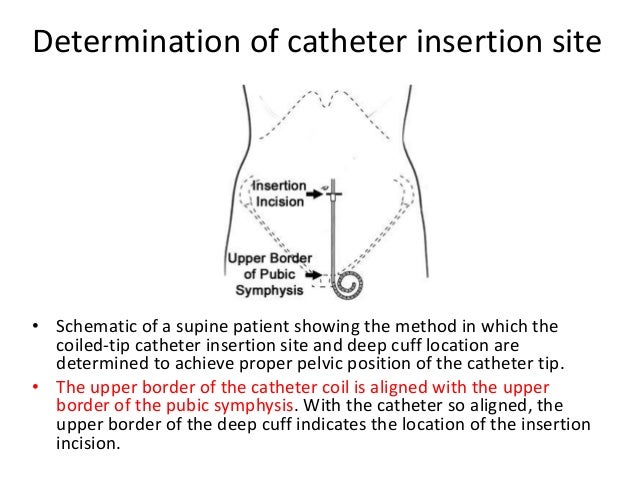 Dr tamer el said pd catheter insertion