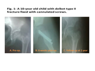 Management of femoral neck fractures in children | PPT
