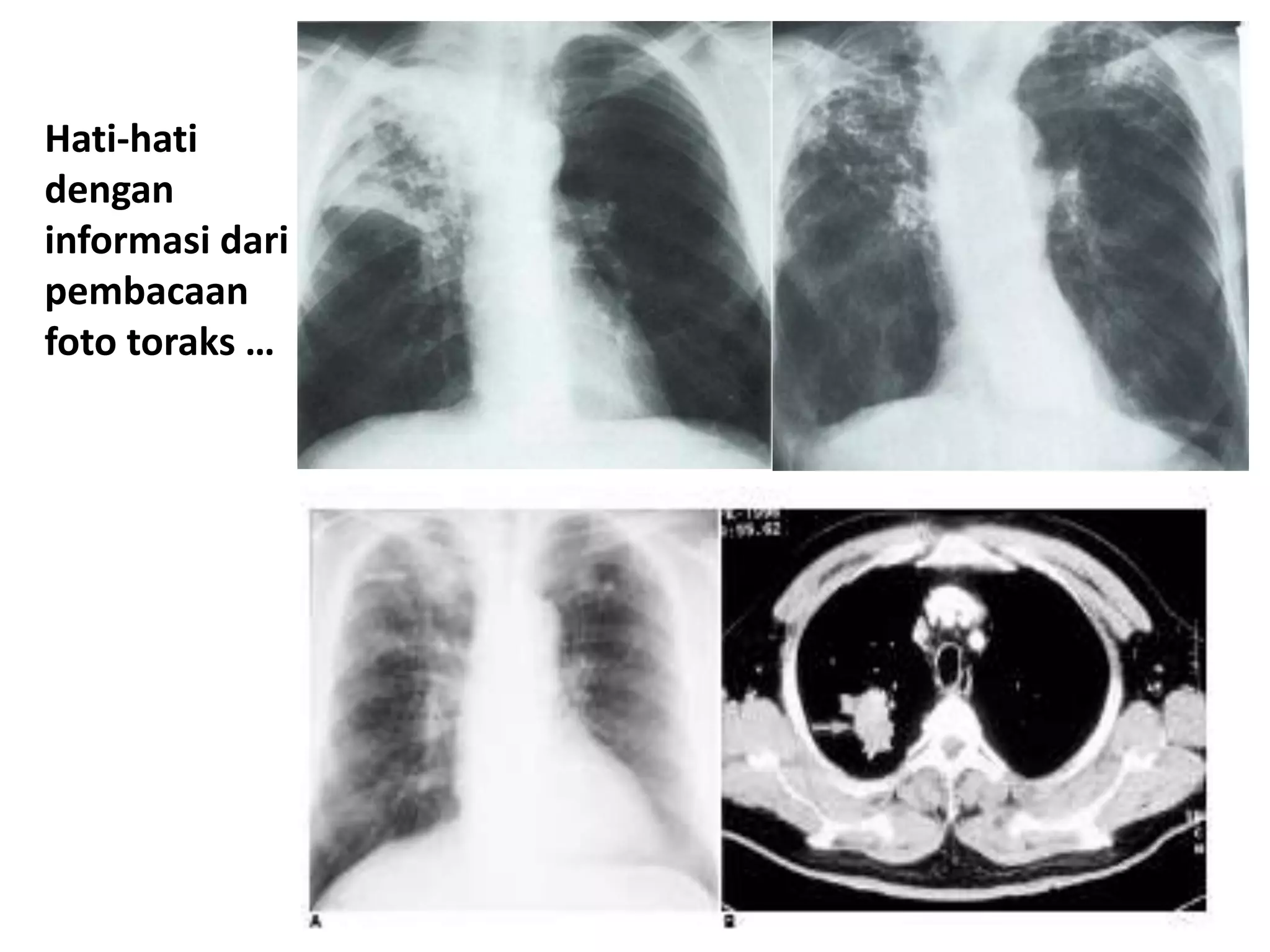 dr Theo- TB Paru FK Uncen.pptx