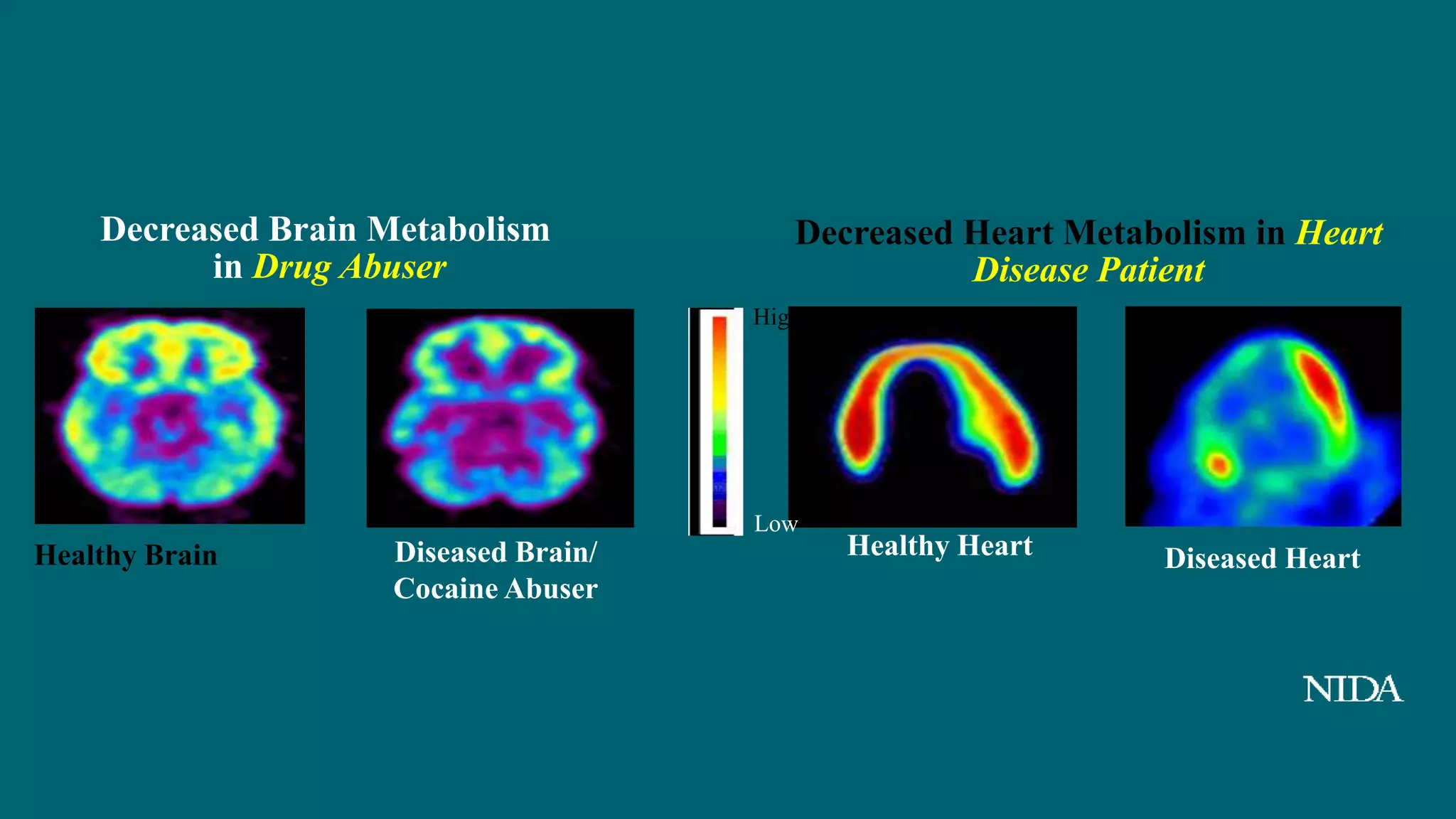 drug addiction as a brain.pptx