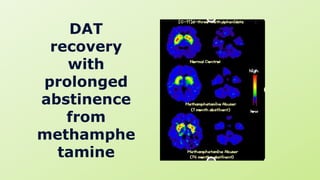 drug addiction as a brain.pptx