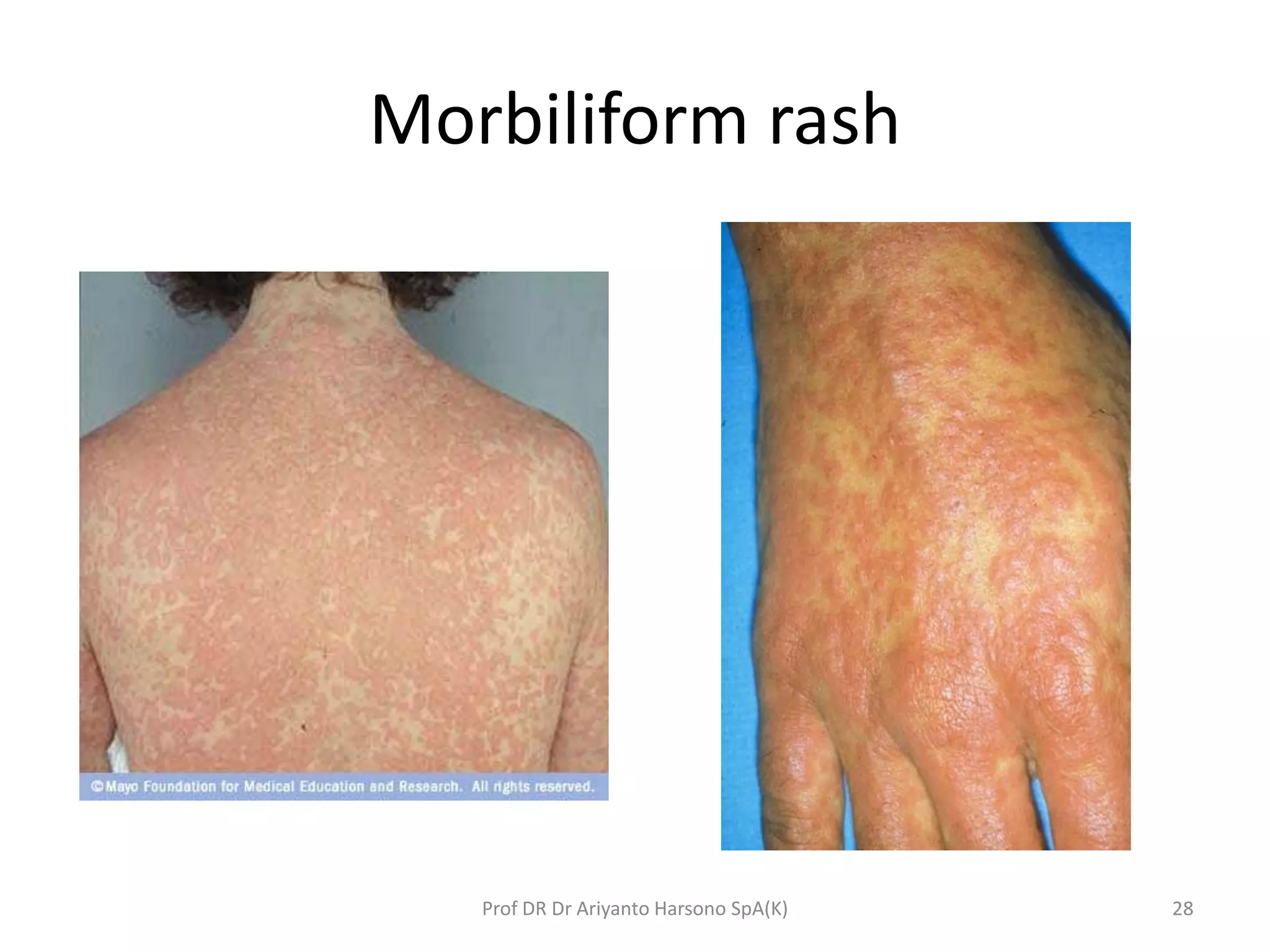 Drug allergy | PPTX