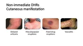 Drug allergy diagnosia and treatment.pptptx | PPT