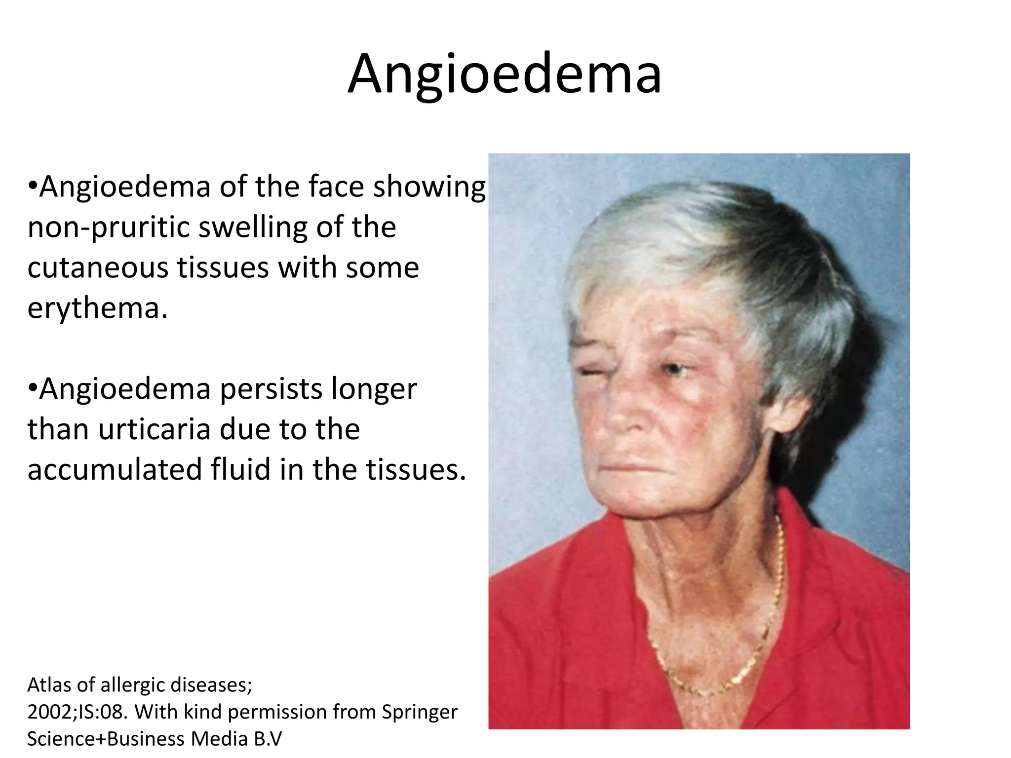 Adverse reaction and drug allergy | PPTX
