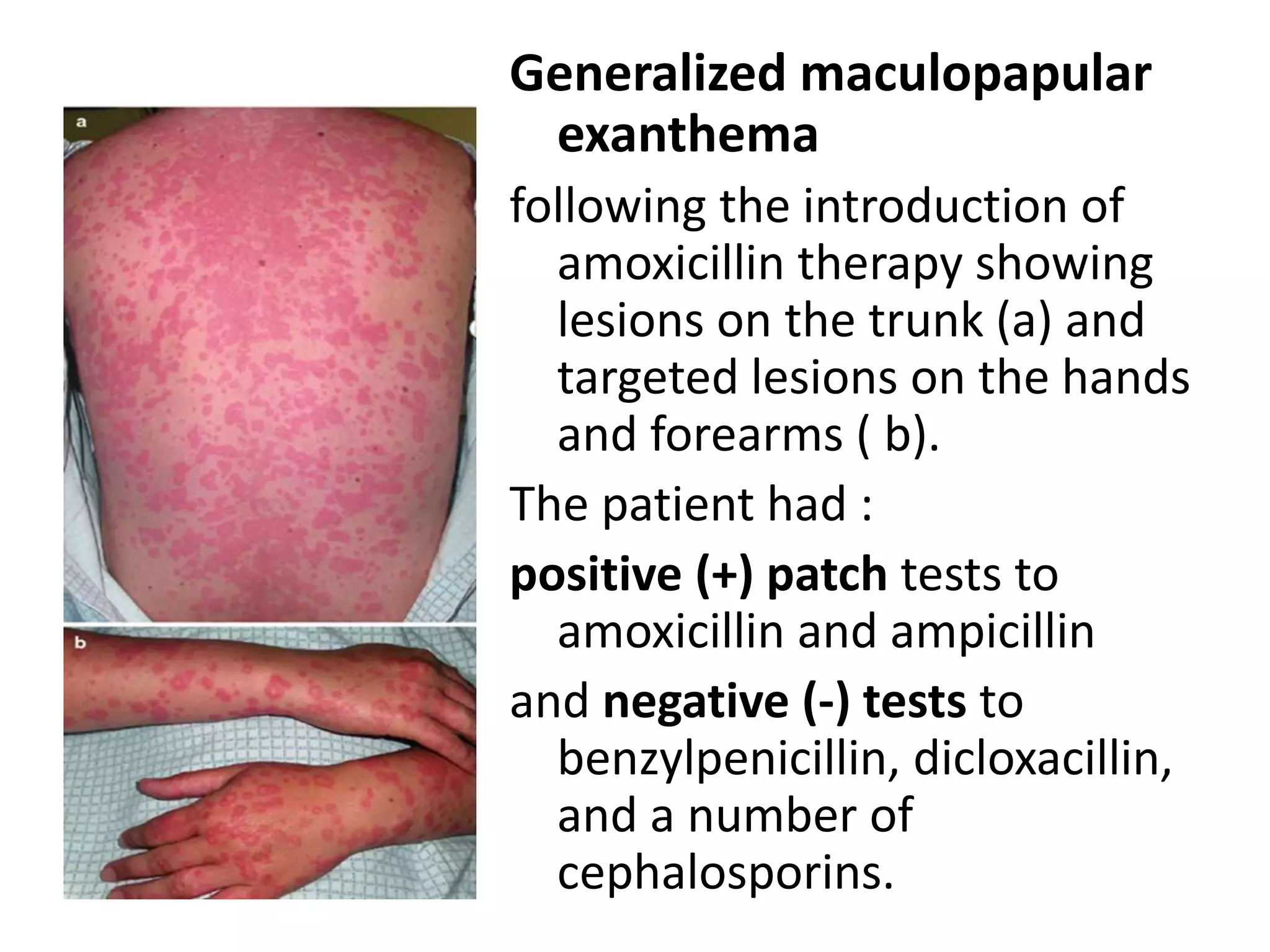 Adverse reaction and drug allergy | PPTX