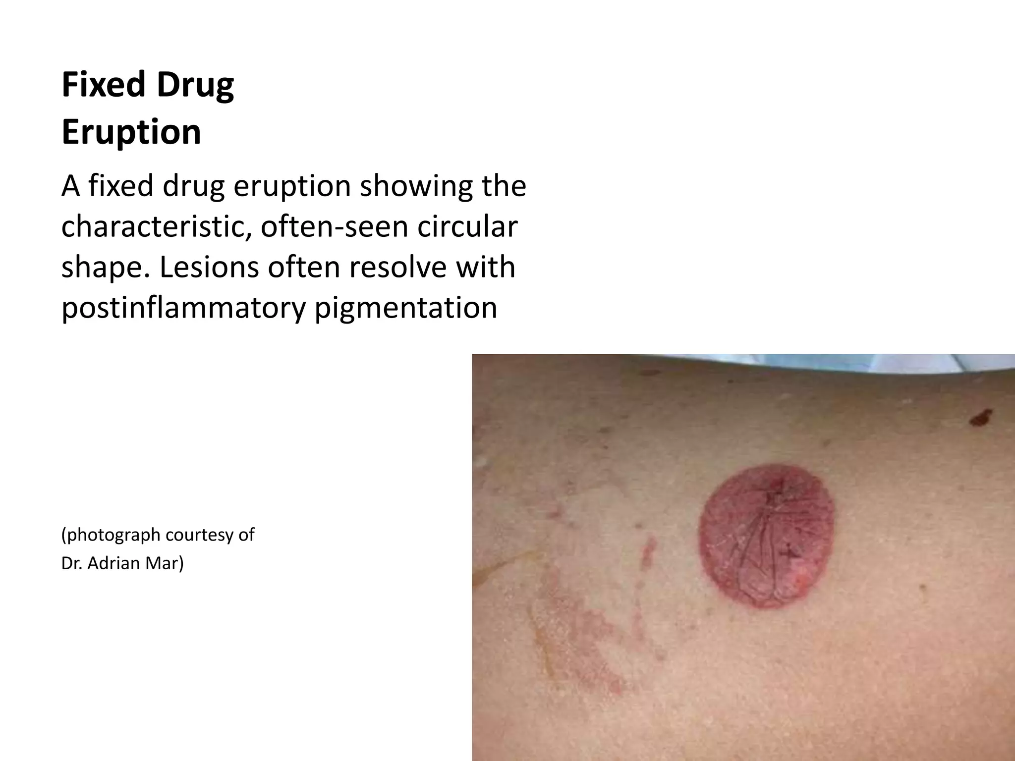 Adverse reaction and drug allergy | PPTX