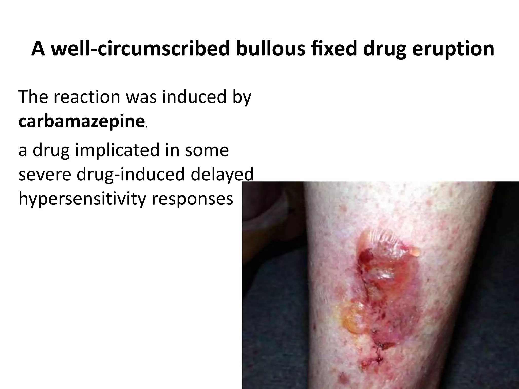 Adverse reaction and drug allergy | PPTX