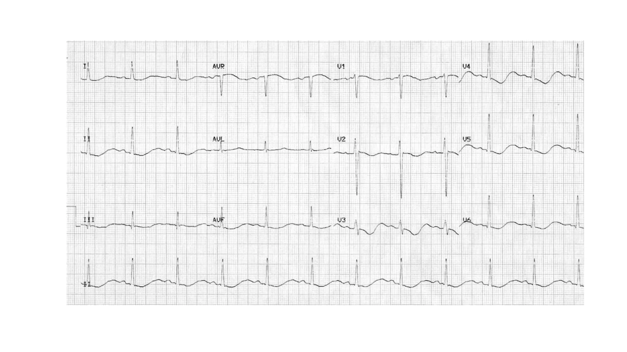 Drug and electrolytes effect on ECG | PPTX