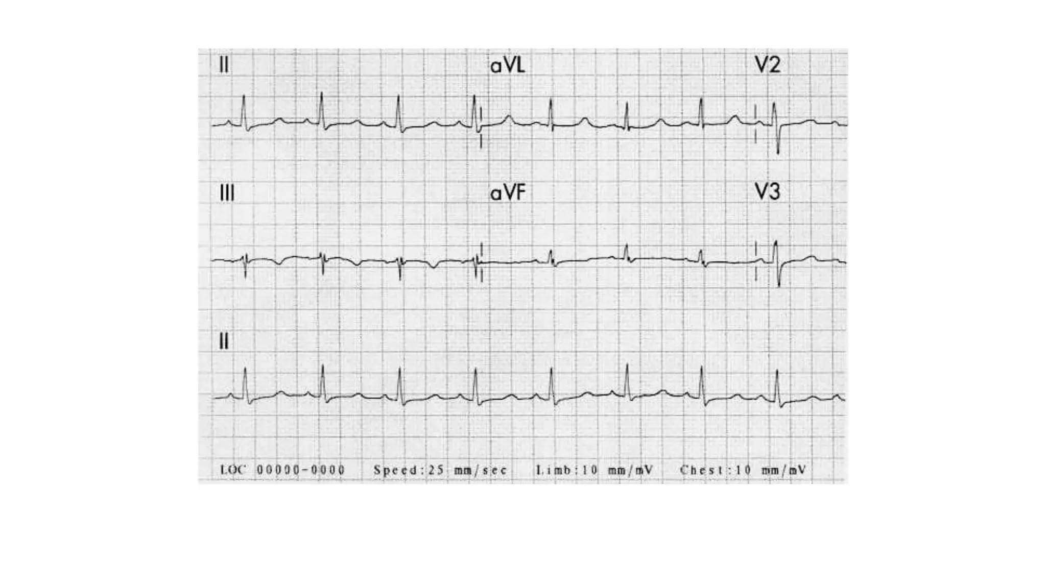 Drug and electrolytes effect on ECG | PPTX