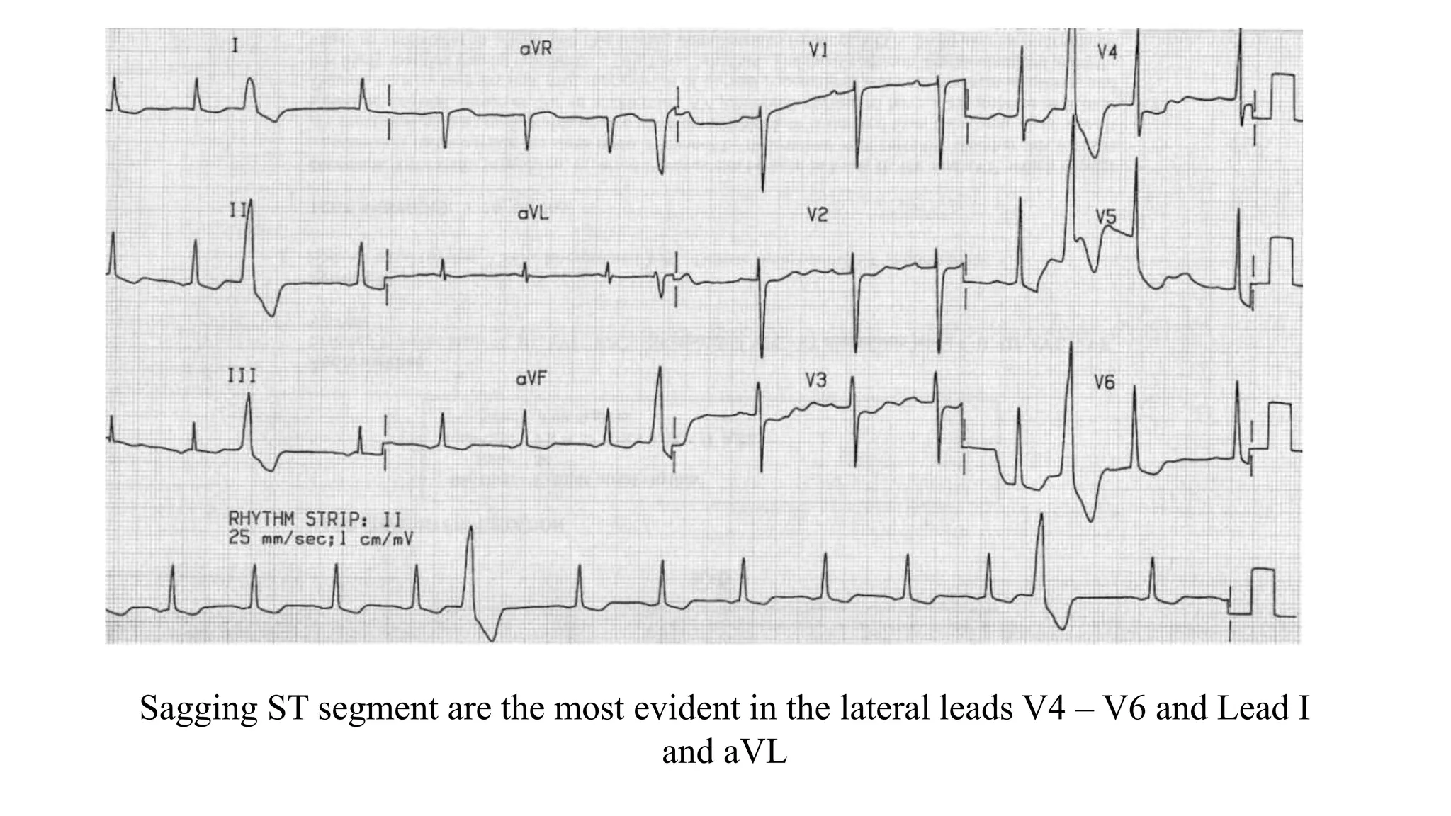 Drug and electrolytes effect on ECG | PPTX