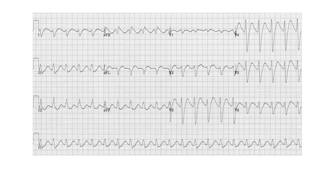 Drug and electrolytes effect on ECG | PPTX | Heart and Cardiovascular ...