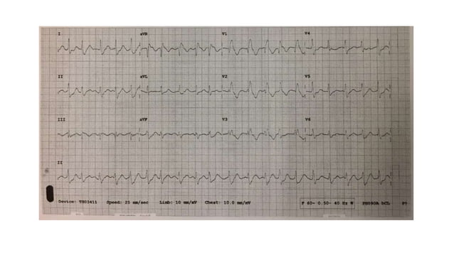 Drug and electrolytes effect on ECG | PPTX | Heart and Cardiovascular ...