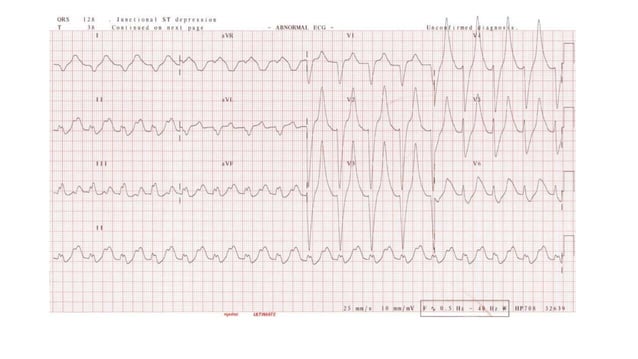 Drug and electrolytes effect on ECG | PPTX | Heart and Cardiovascular ...