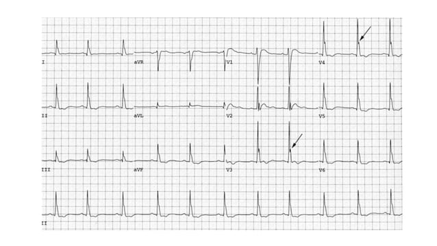 Drug and electrolytes effect on ECG | PPTX | Heart and Cardiovascular ...