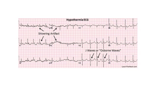 Drug and electrolytes effect on ECG | PPTX | Heart and Cardiovascular ...