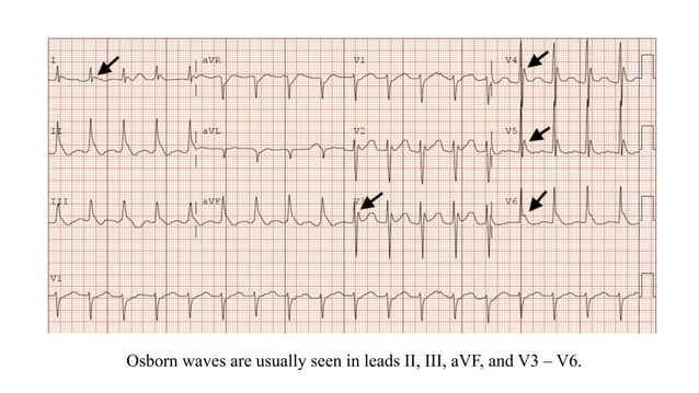 Drug and electrolytes effect on ECG | PPTX | Heart and Cardiovascular ...